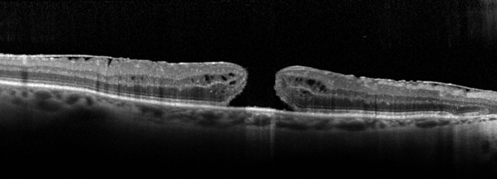 Trou maculaire | Cabinet Ophtalmologie Dr Khanaouchi
